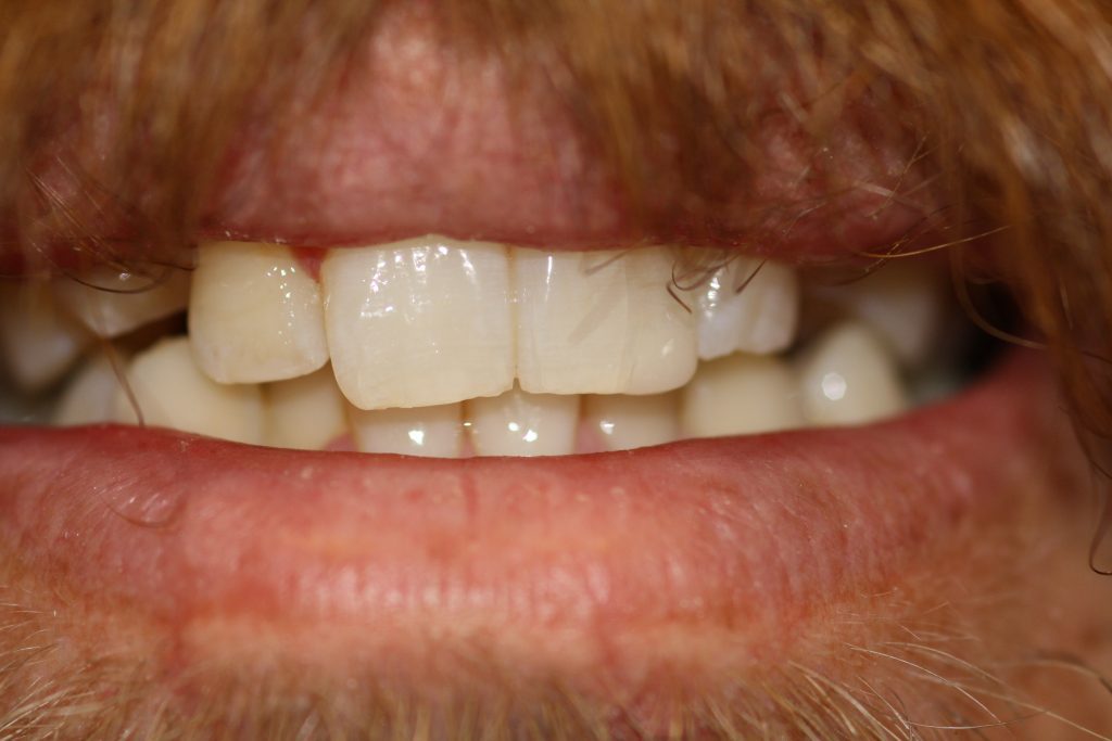 Chipped Tooth-What To Do? - North Austin Dentistry - Logan Miller, DDS