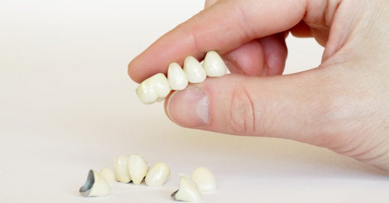 Choosing Between Dental Bridges and Partial Dentures - North Austin ...